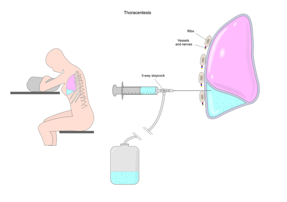 Safe Patient Positioning with the EPD During Thoracentesis