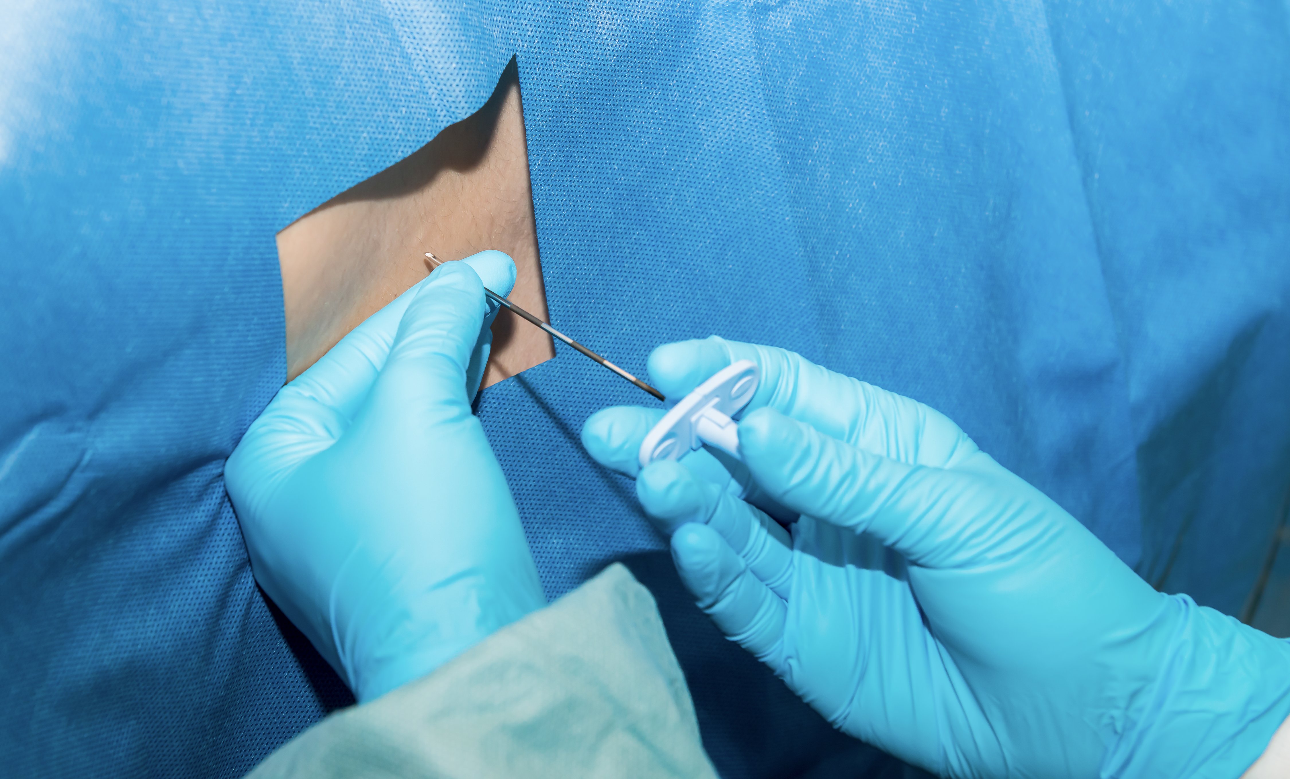 Practical Tips For Managing Super Morbidly Obese Patients